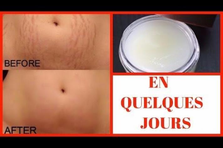 Crème maison efficace pour traiter les vergetures