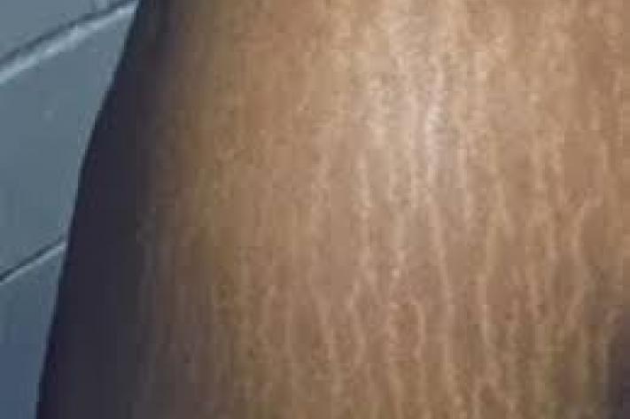 Vergetures : faut-il les prévenir ou s'en accommoder